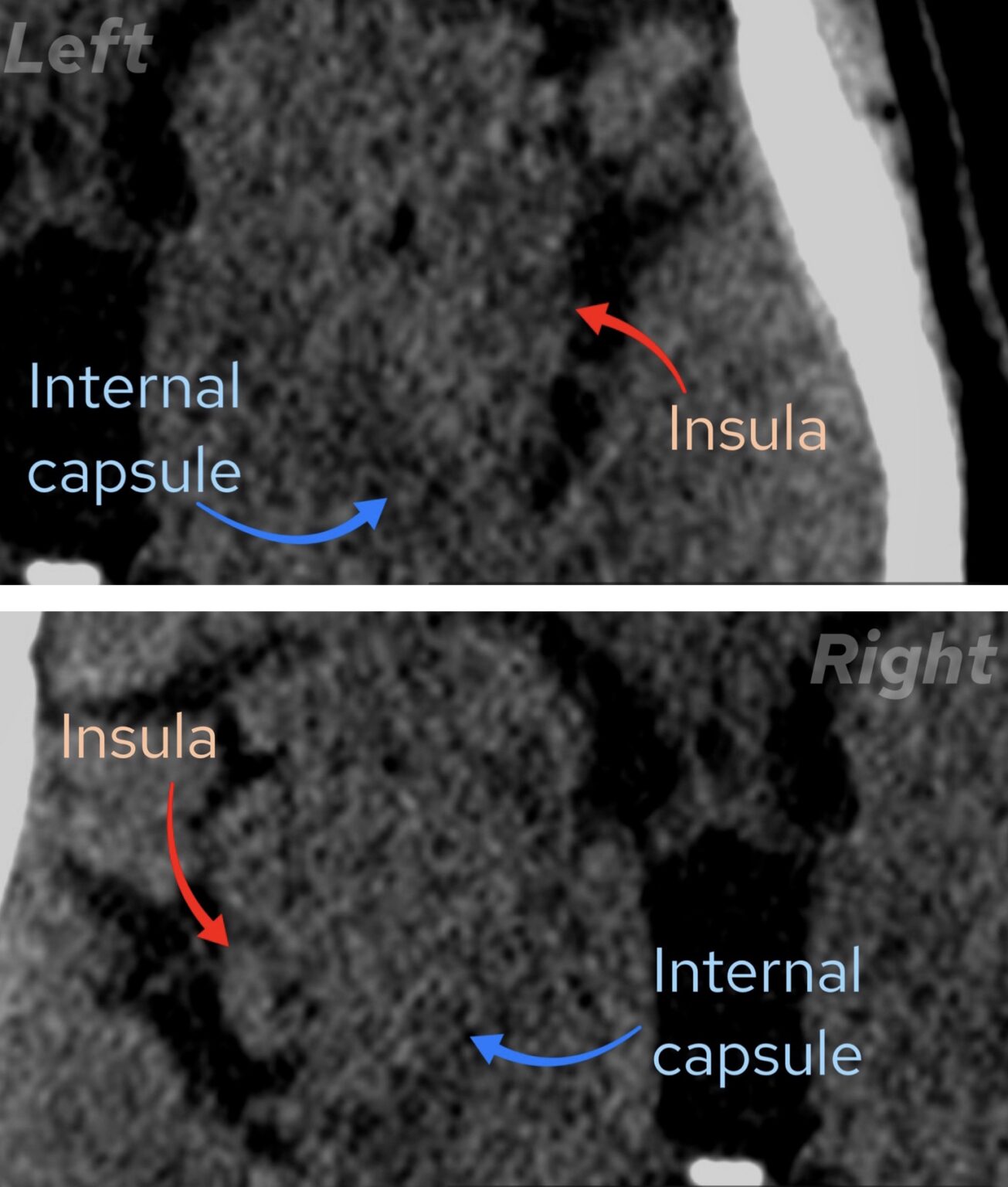 Early MCA territory infarcts – the Radiologist