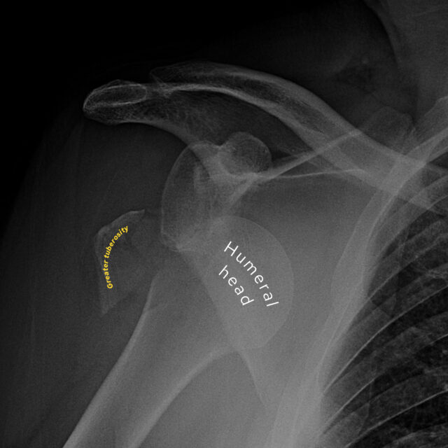 Shoulder dislocation – the Radiologist
