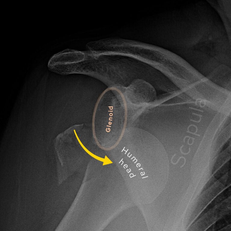 Shoulder Dislocation X-ray | Anterior Dislocation Signs