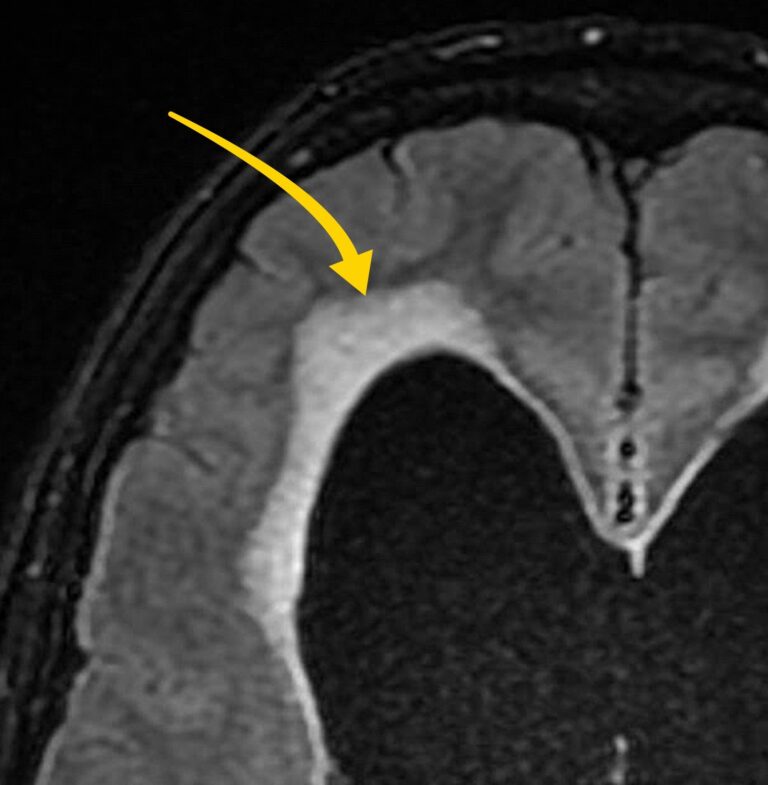 Colloid cyst – the Radiologist