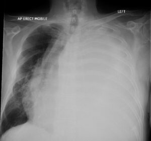 White-out chest X-ray – the Radiologist