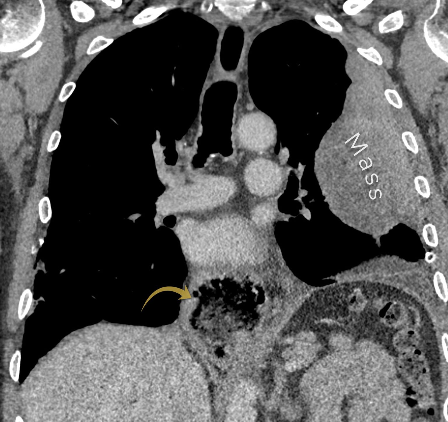 White-out chest X-ray – the Radiologist
