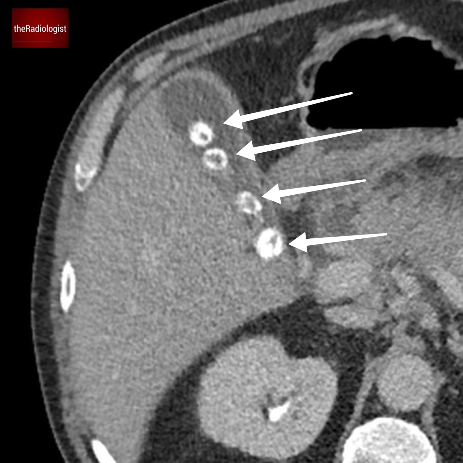 Acute pancreatitis – the Radiologist