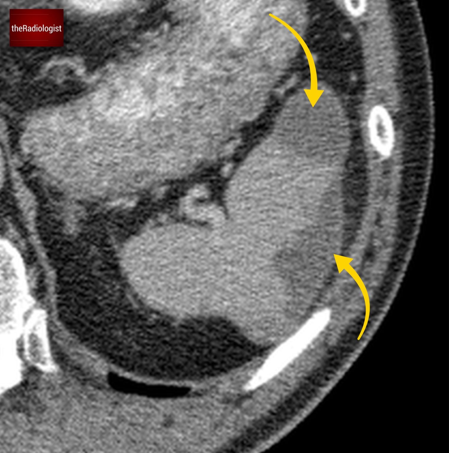 Splenic infarct – the Radiologist