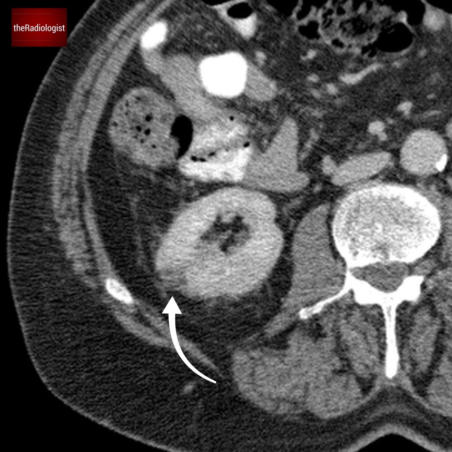 Splenic infarct – the Radiologist
