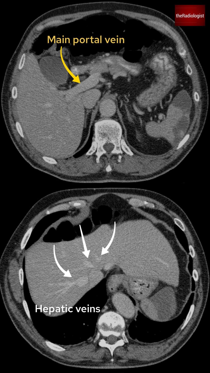 Splenic infarct – the Radiologist