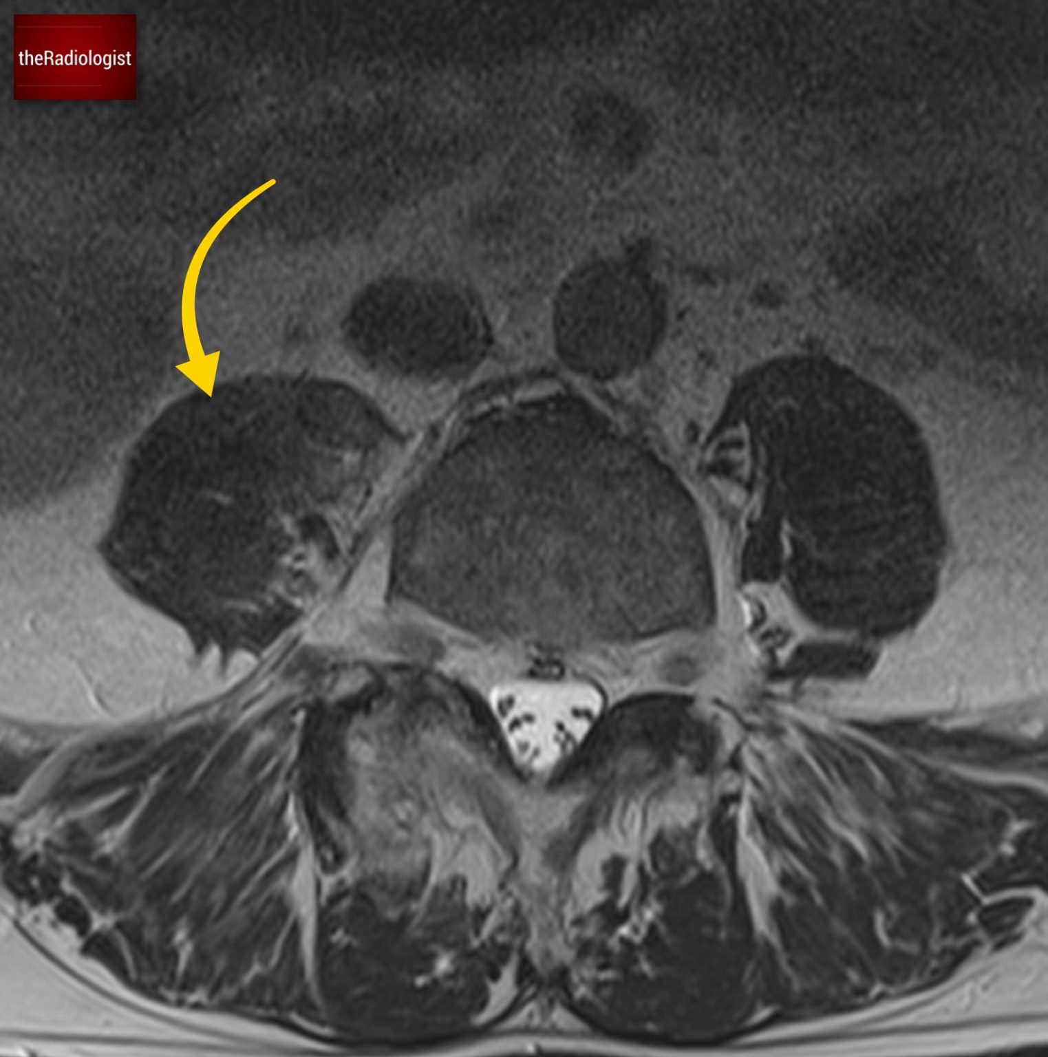 Psoas Abscess Radiology | CT and MRI Case