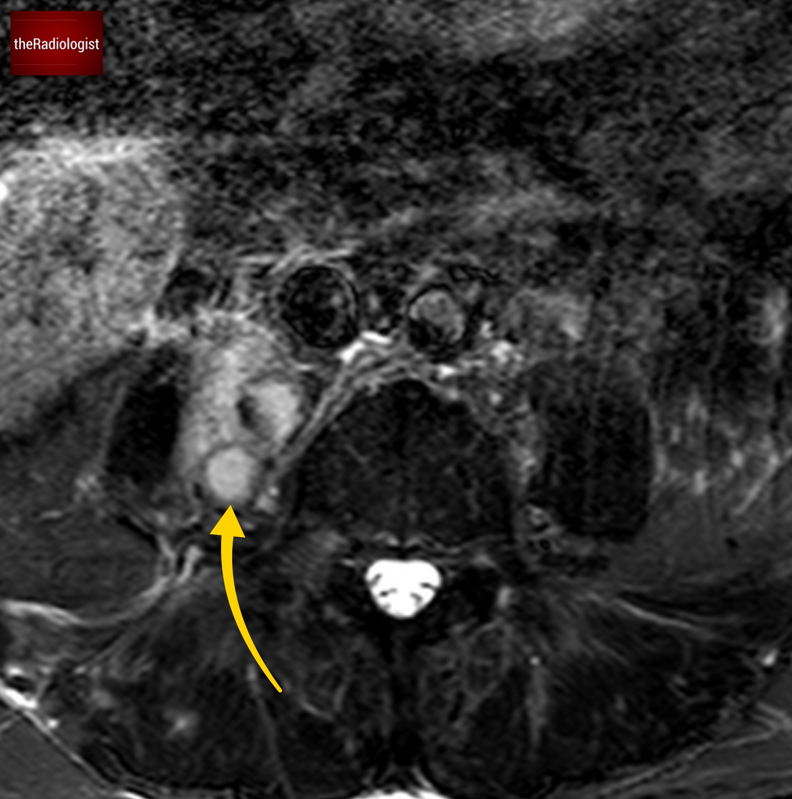 Psoas abscess – the Radiologist