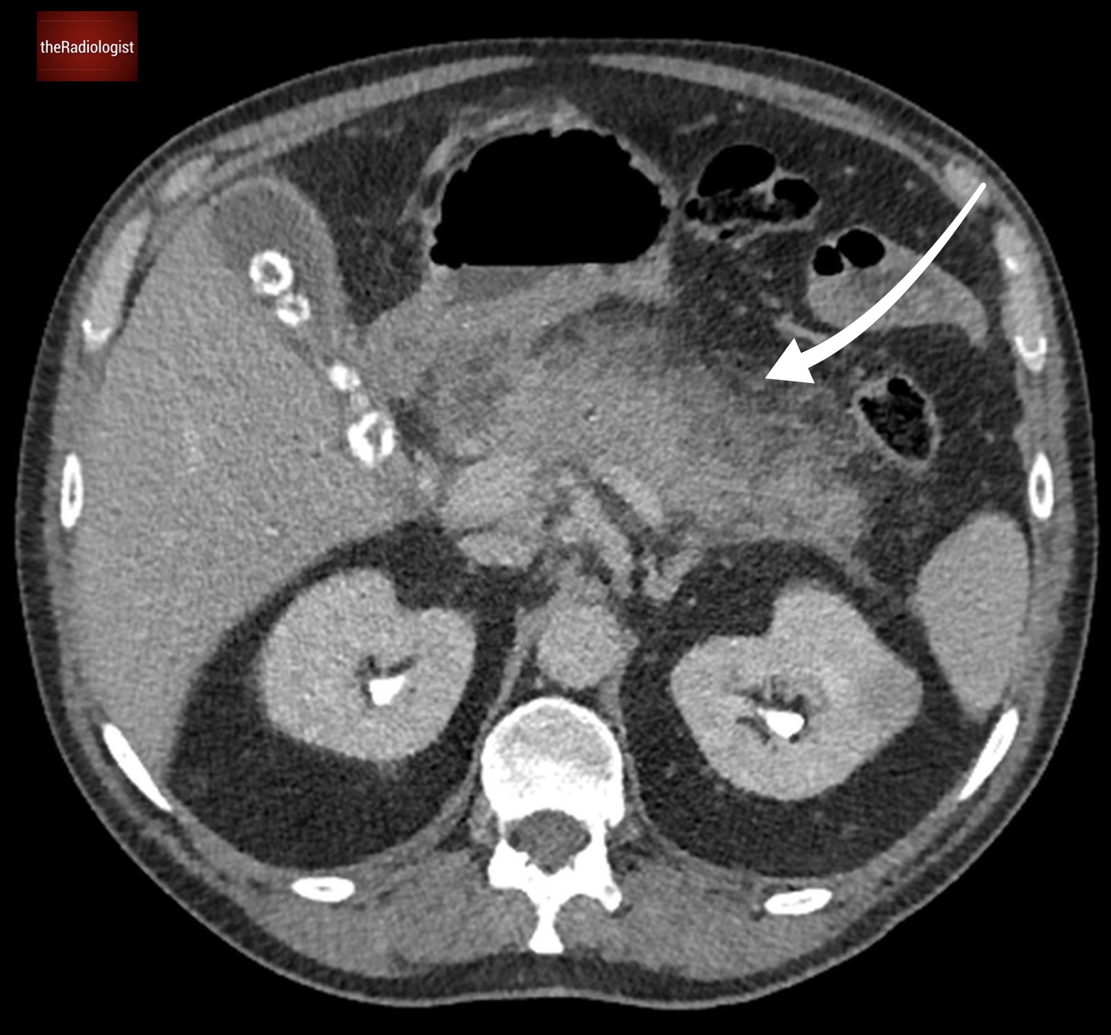 Acute pancreatitis - the Radiologist