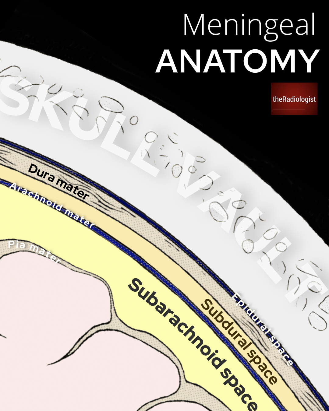 Subarachnoid haemorrhage - the Radiologist