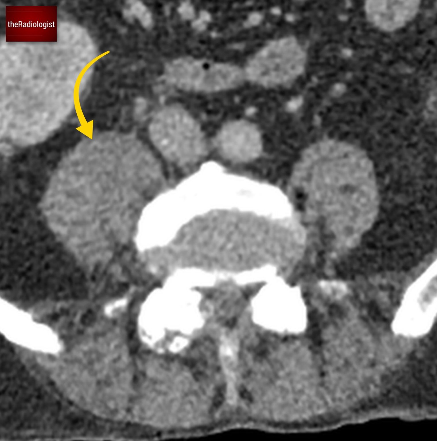 Psoas Abscess Radiology | CT and MRI Case