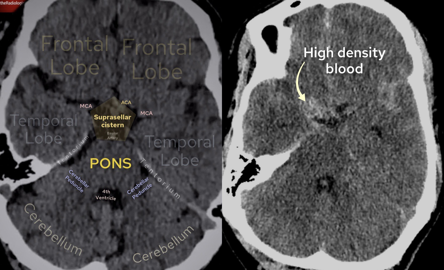 Subarachnoid haemorrhage – the Radiologist
