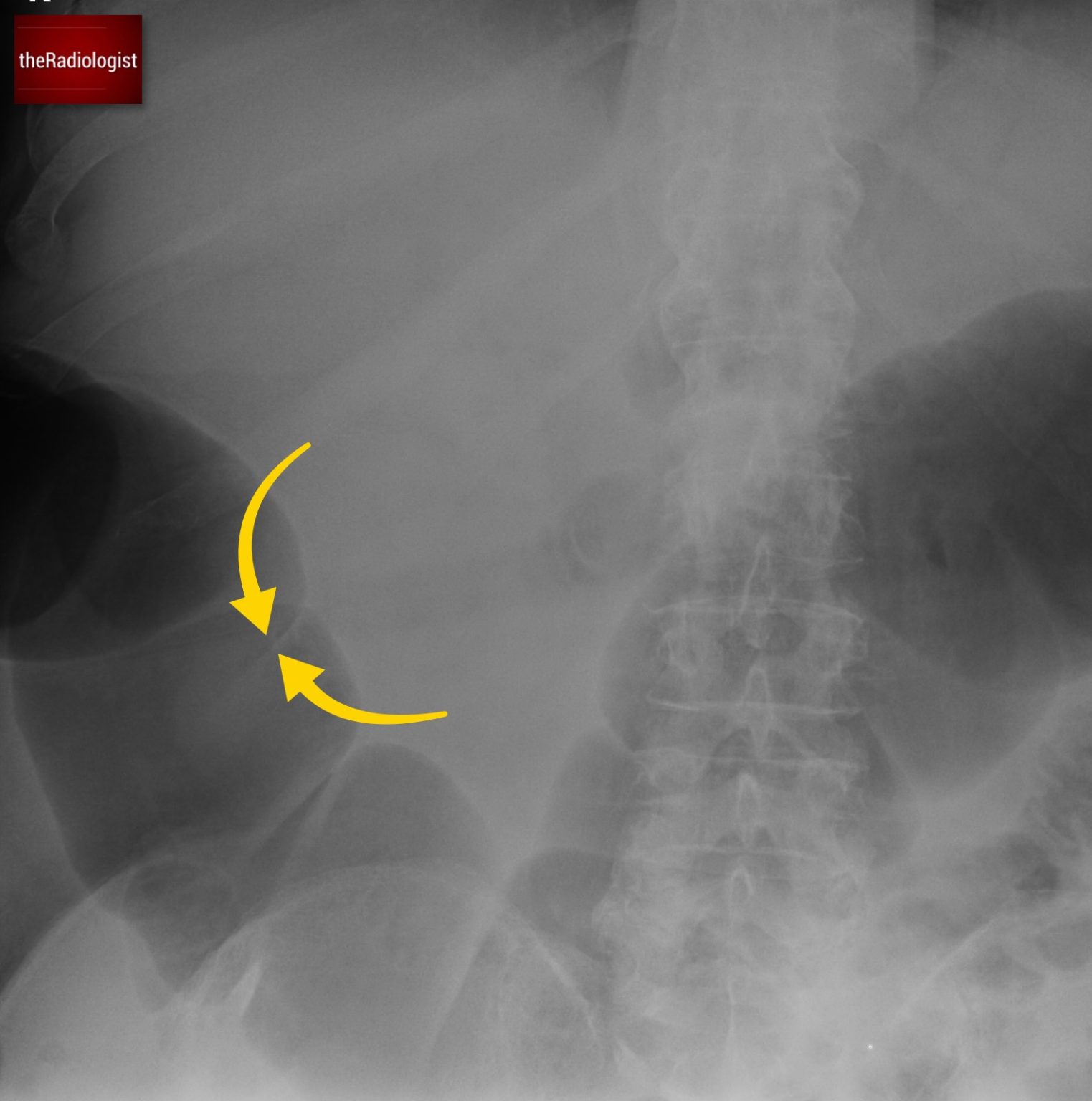 Large bowel obstruction – the Radiologist
