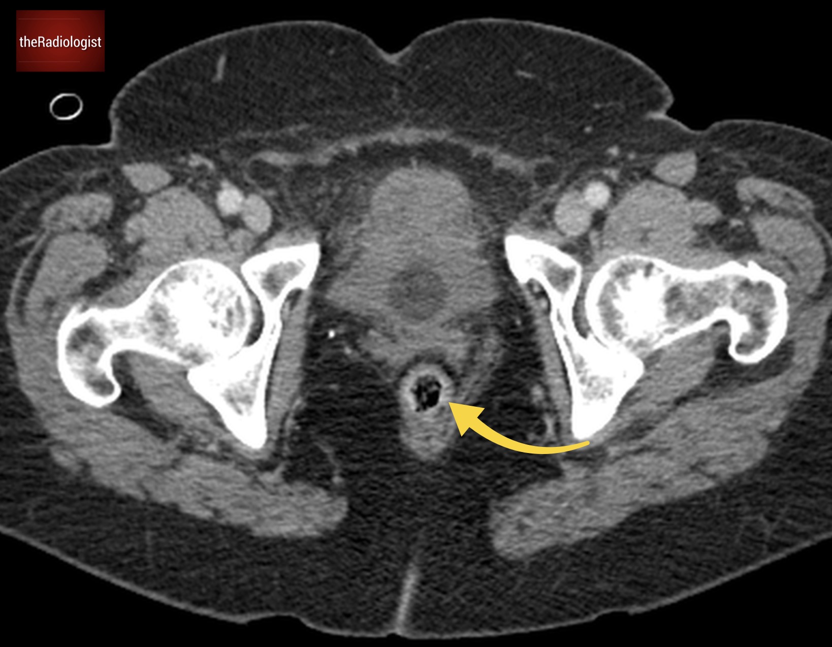 Small bowel obstruction – the Radiologist