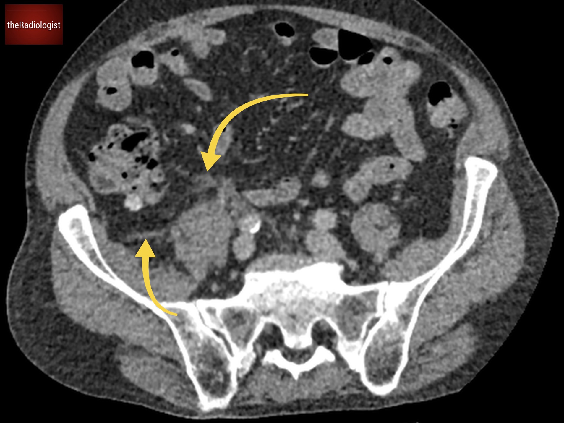 Psoas Abscess Radiology | CT and MRI Case
