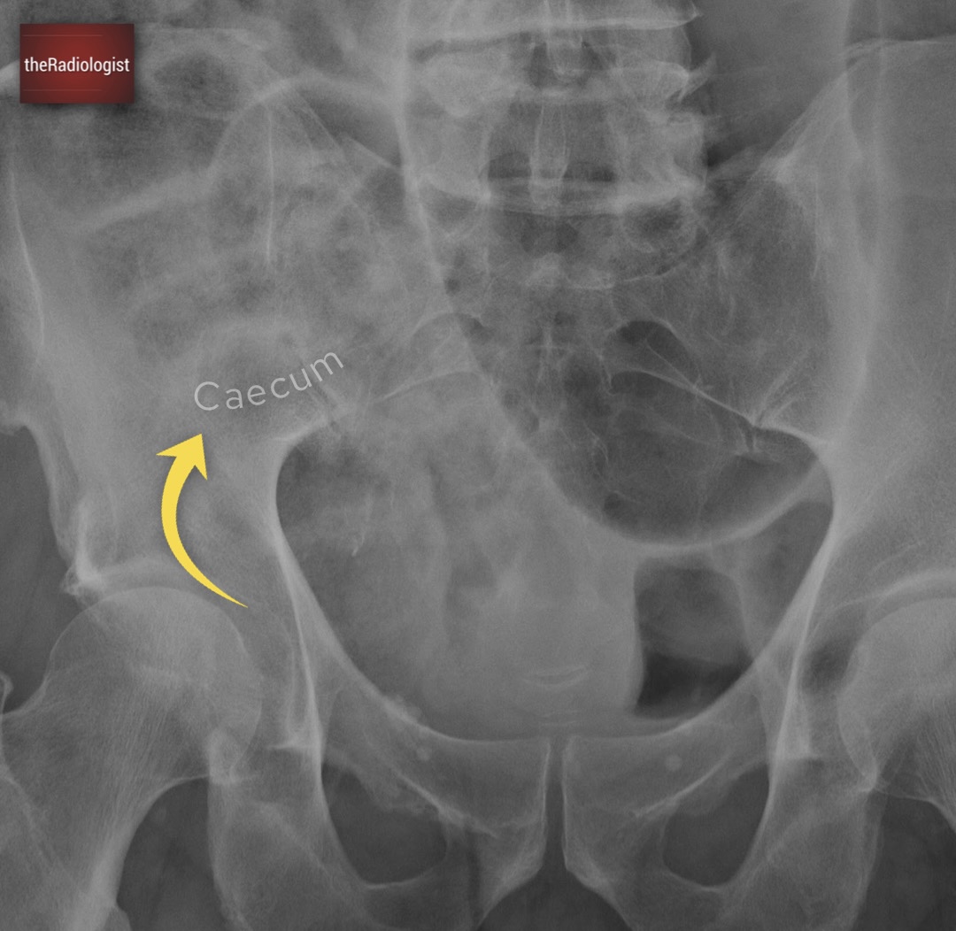 Sigmoid volvulus – the Radiologist