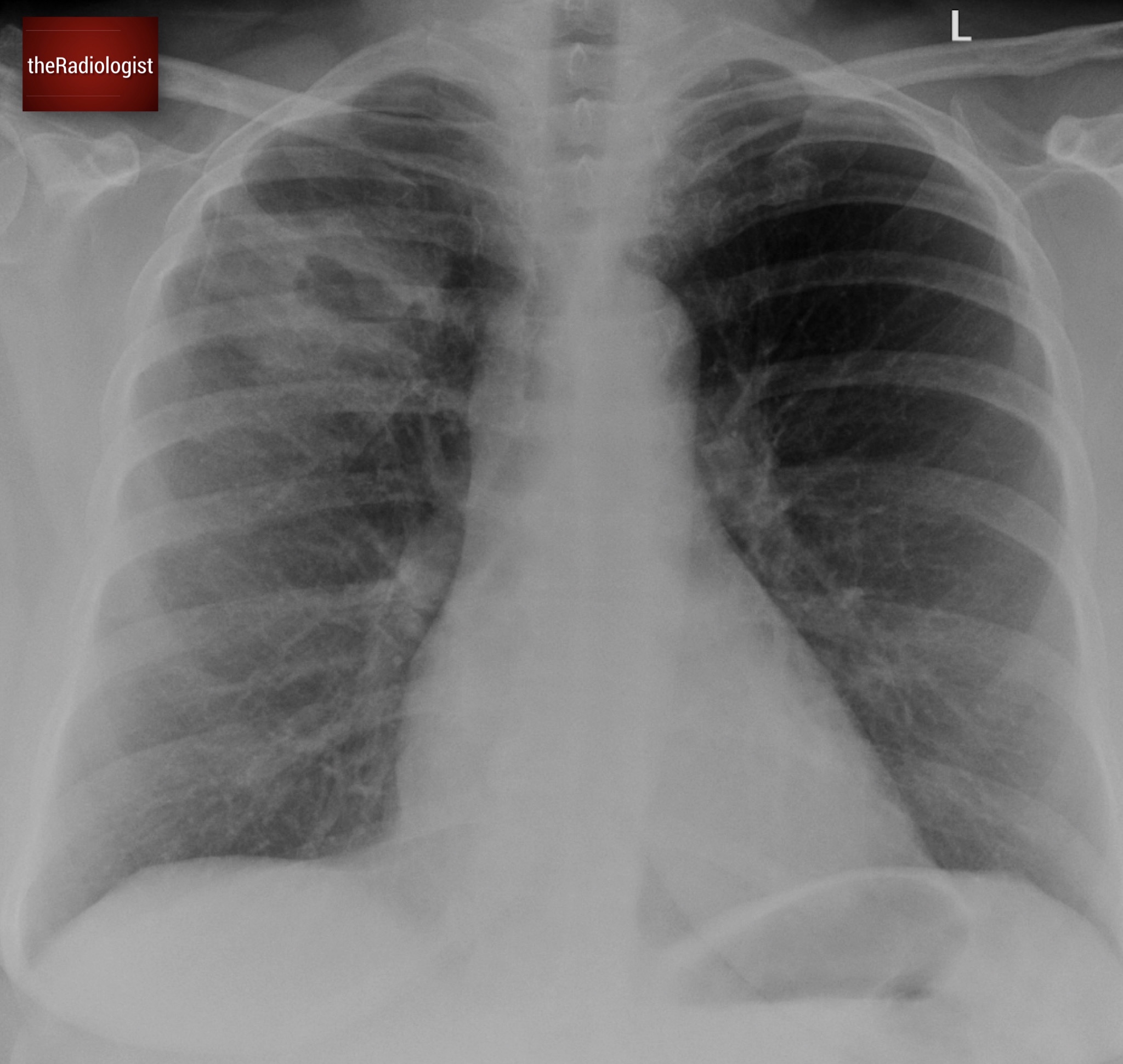 Single cavitating lesion – the Radiologist