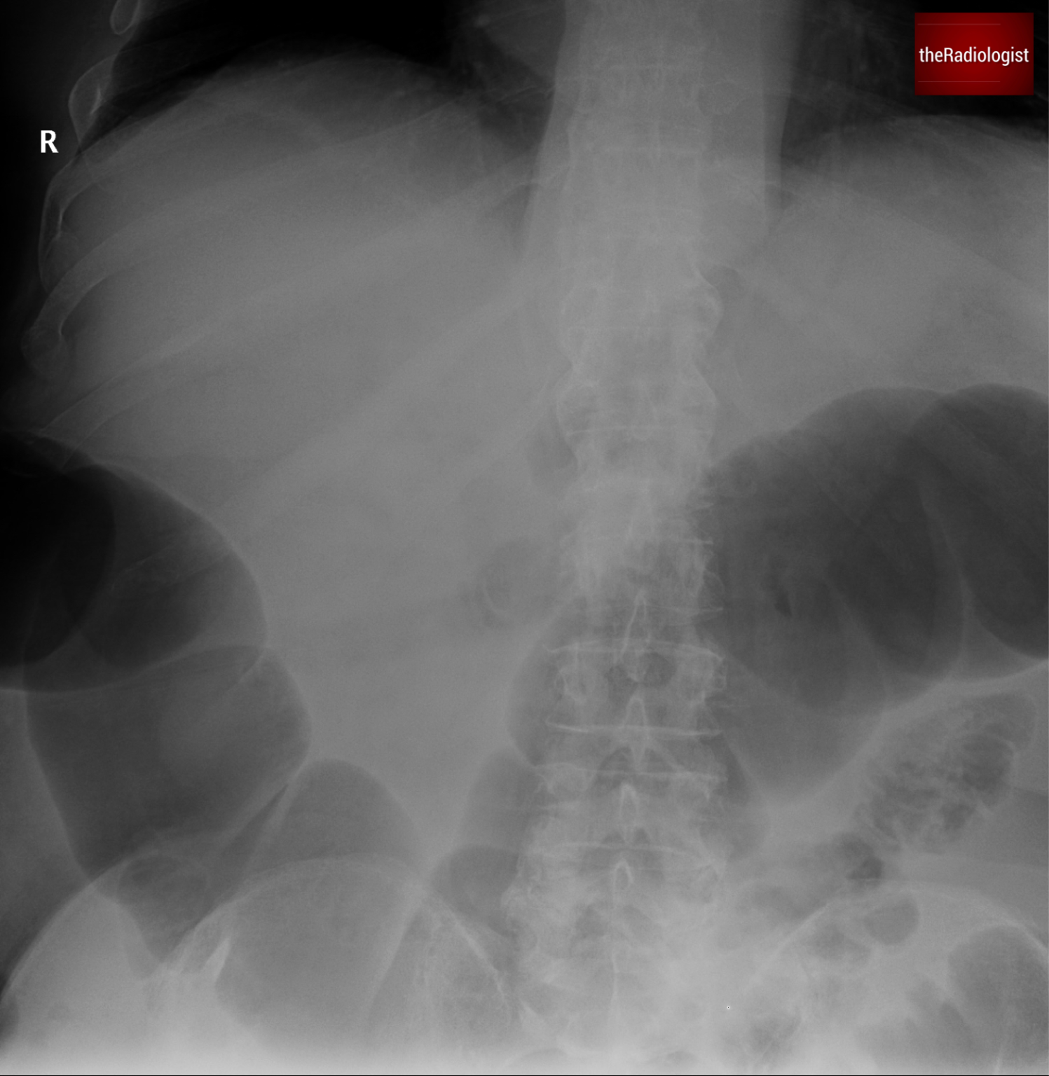 Large Bowel Obstruction X-ray | Key Signs and CT Correlation
