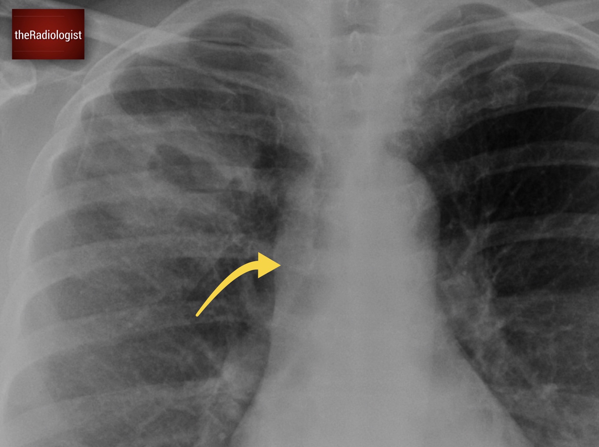 Single cavitating lesion - the Radiologist