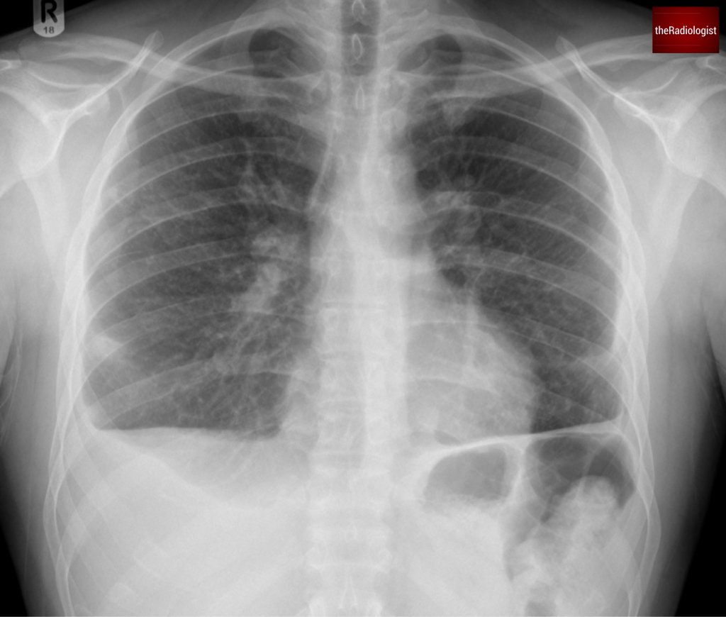 Septic emboli – the Radiologist