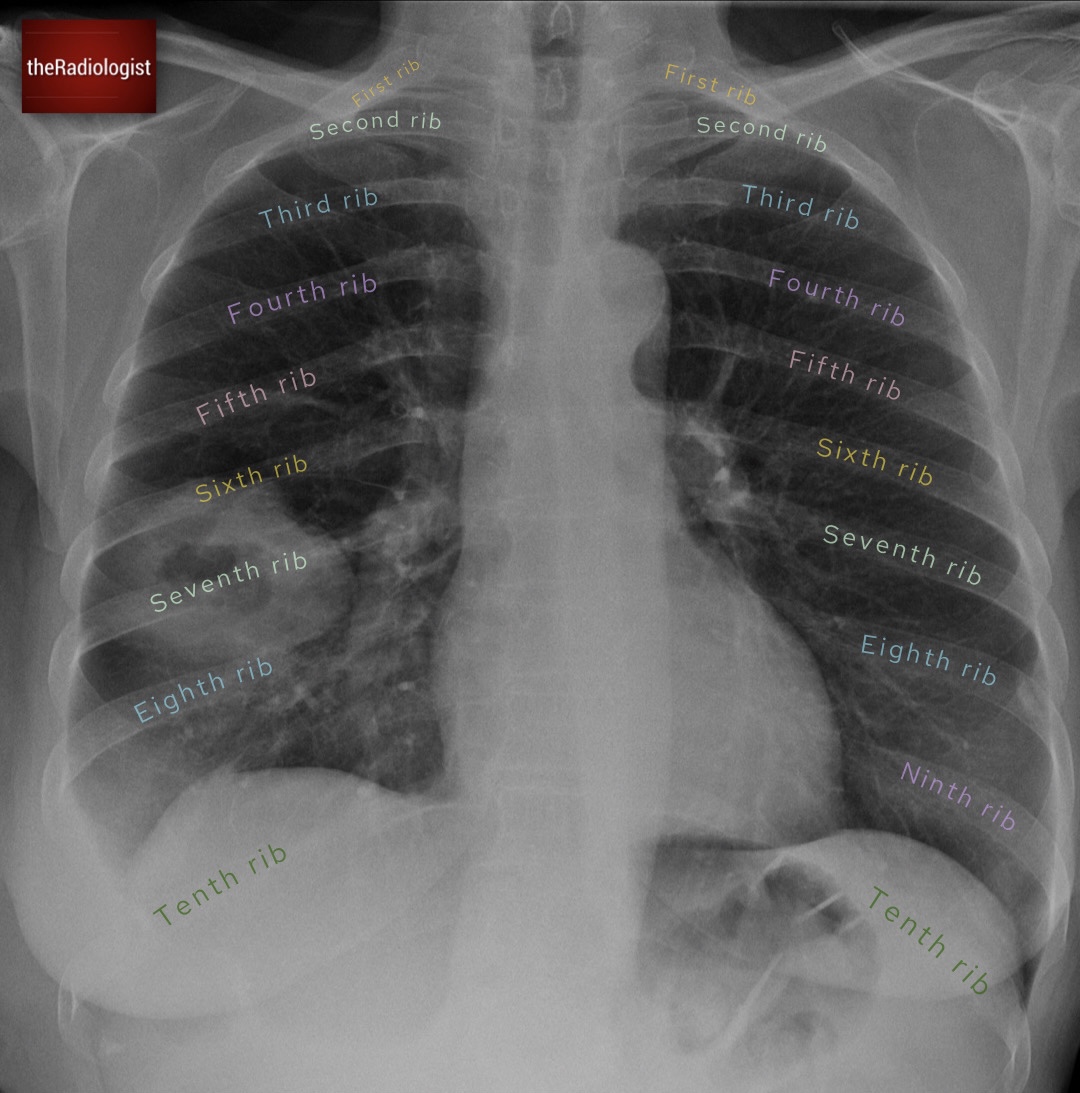 Single cavitating lesion – the Radiologist