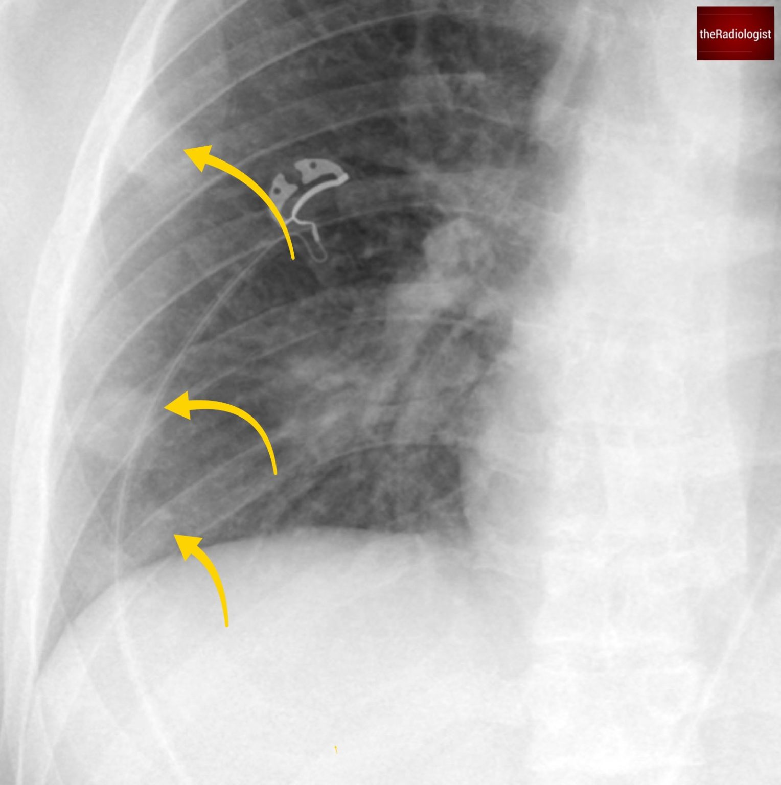 Septic emboli – the Radiologist