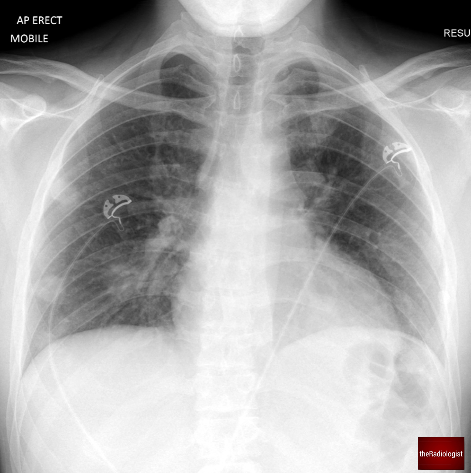 Septic Emboli Radiology | CXR and CT Chest Features