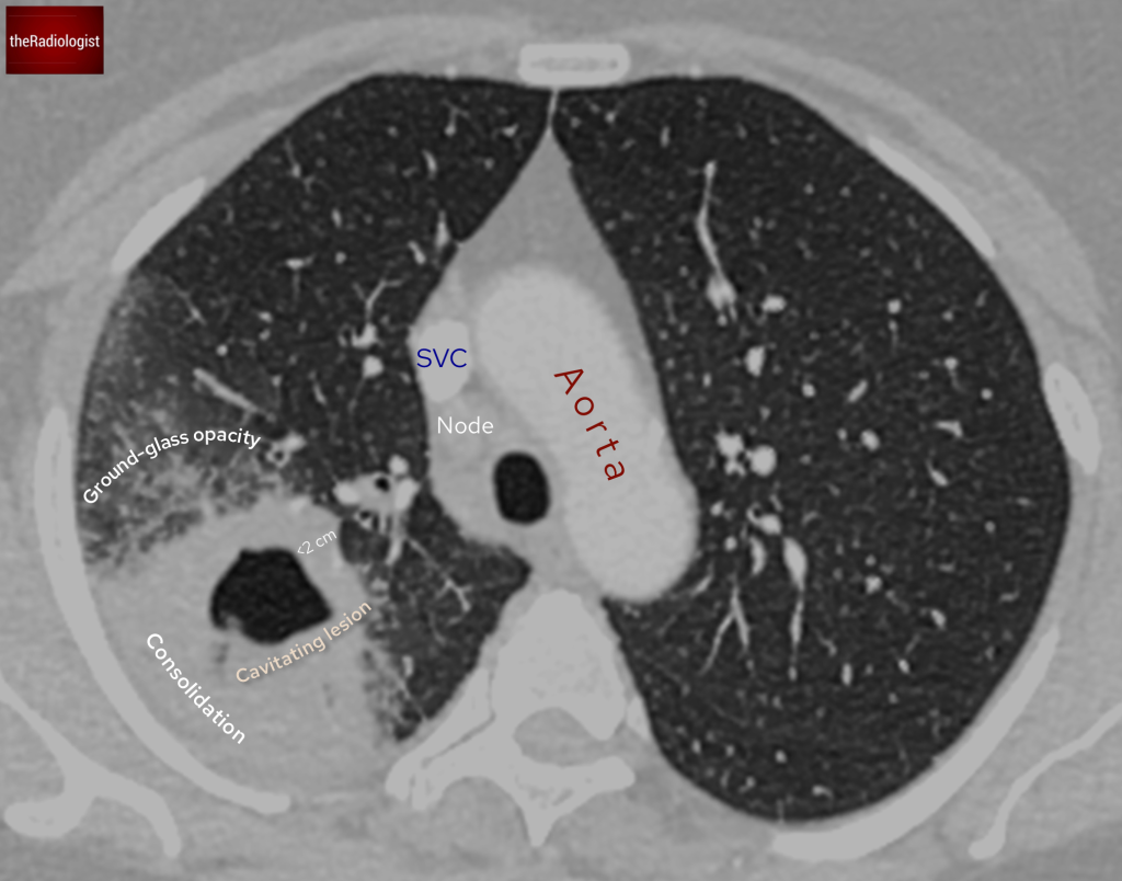 Single cavitating lesion – the Radiologist