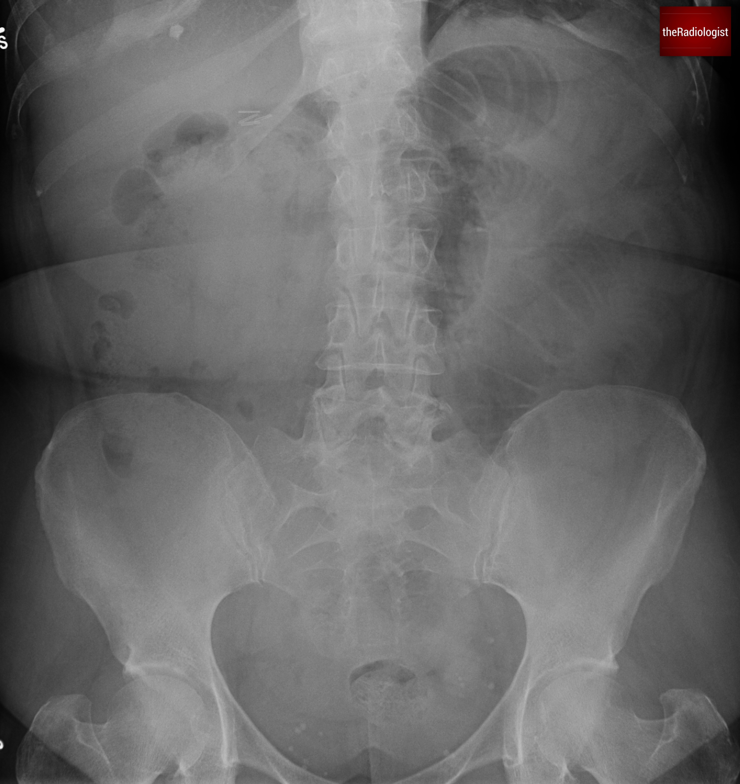 Dilated Bowel Loops | Small Bowel Obstruction X-Ray Signs