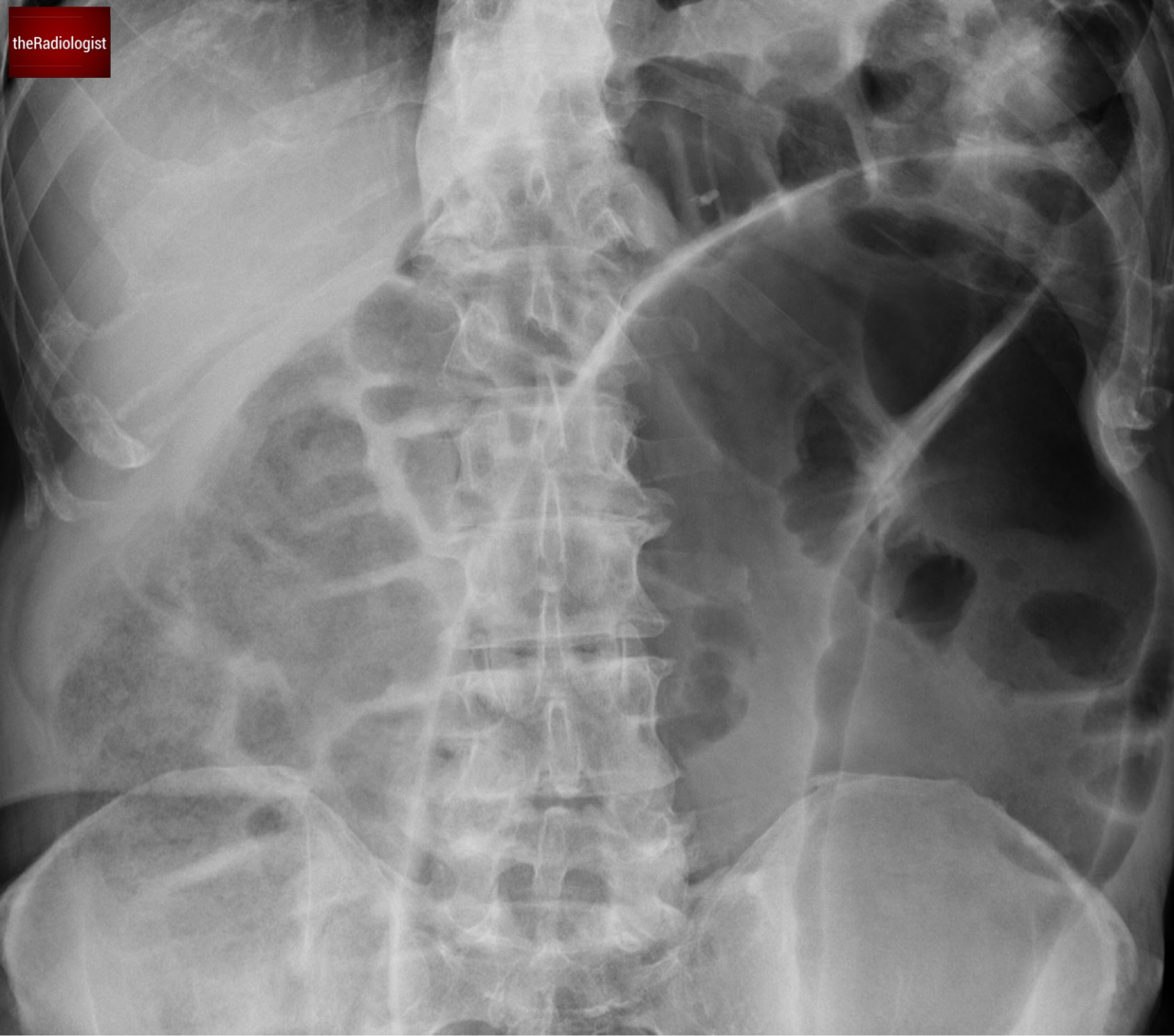 Sigmoid volvulus – the Radiologist