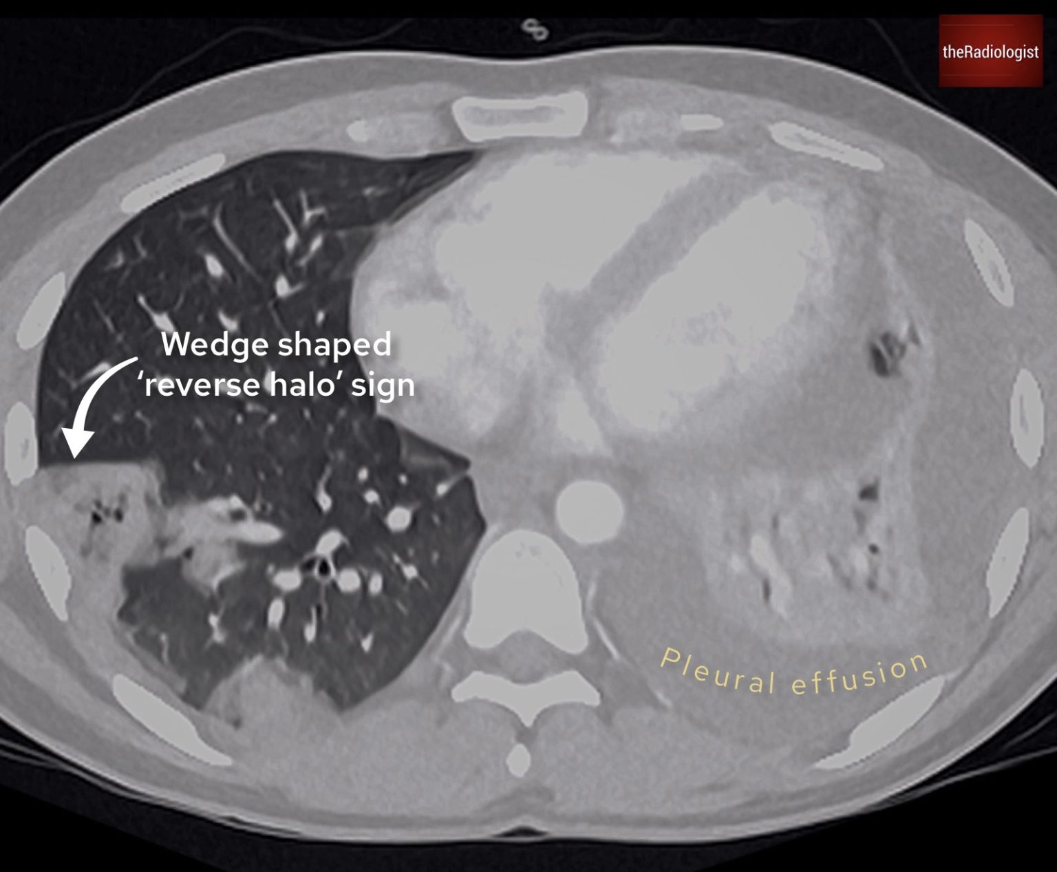 Septic emboli – the Radiologist