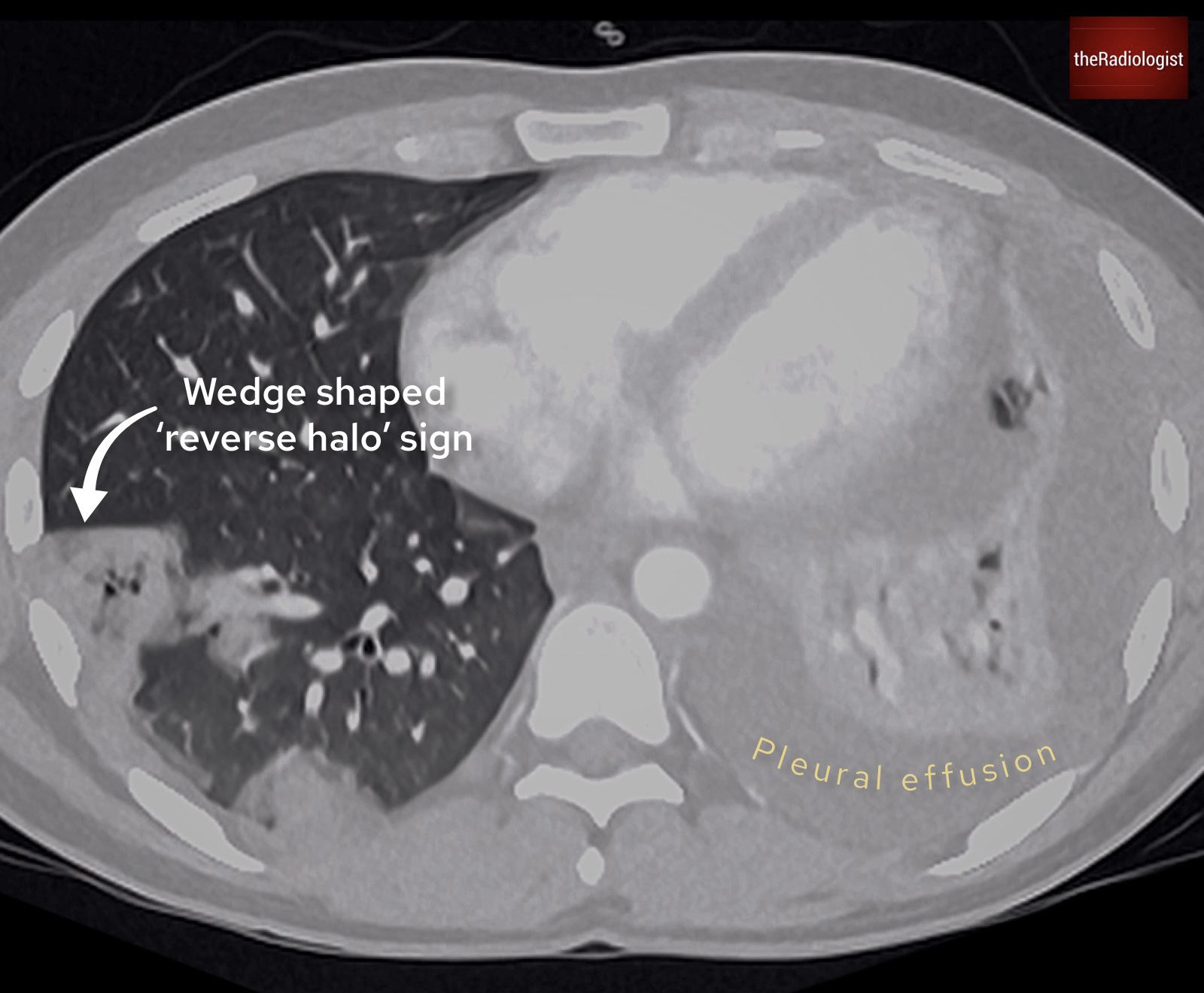Septic emboli – the Radiologist