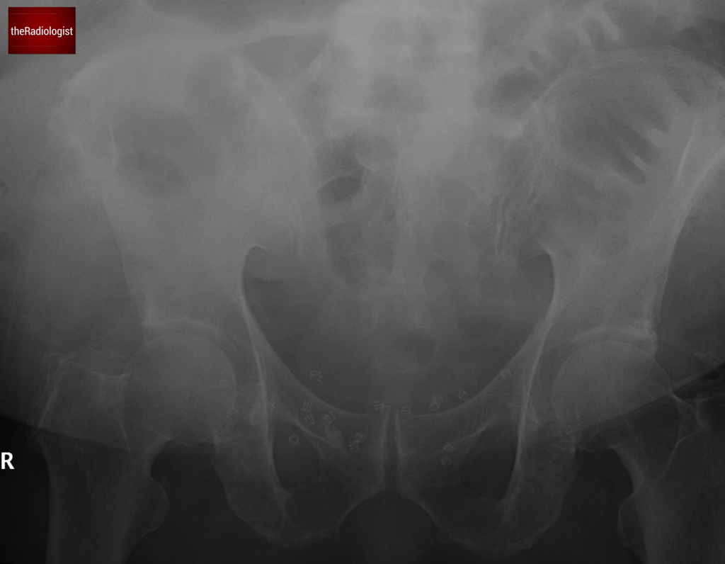 Large bowel obstruction – the Radiologist