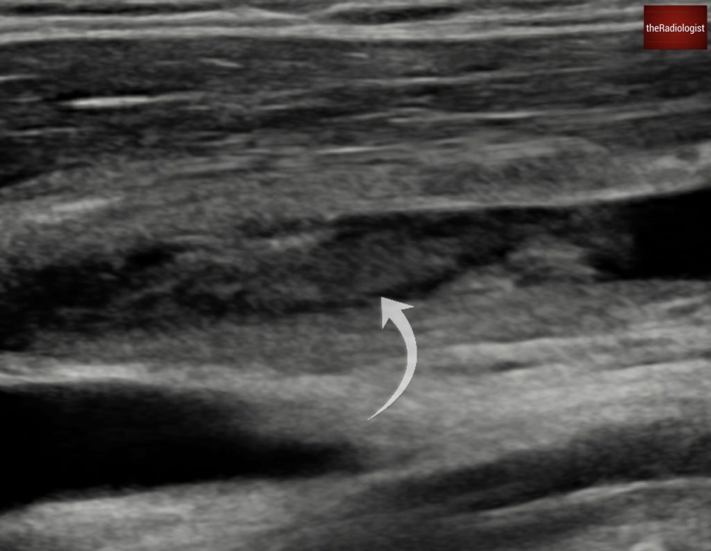 Septic emboli – the Radiologist