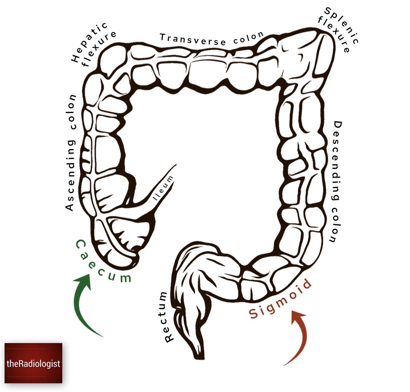 Sigmoid volvulus – the Radiologist