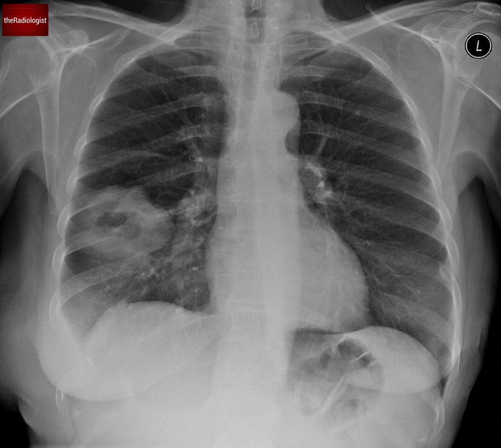 Single cavitating lesion – the Radiologist