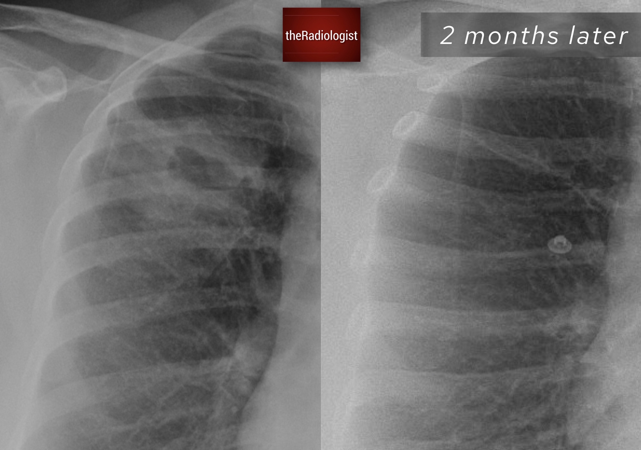 Single cavitating lesion – the Radiologist