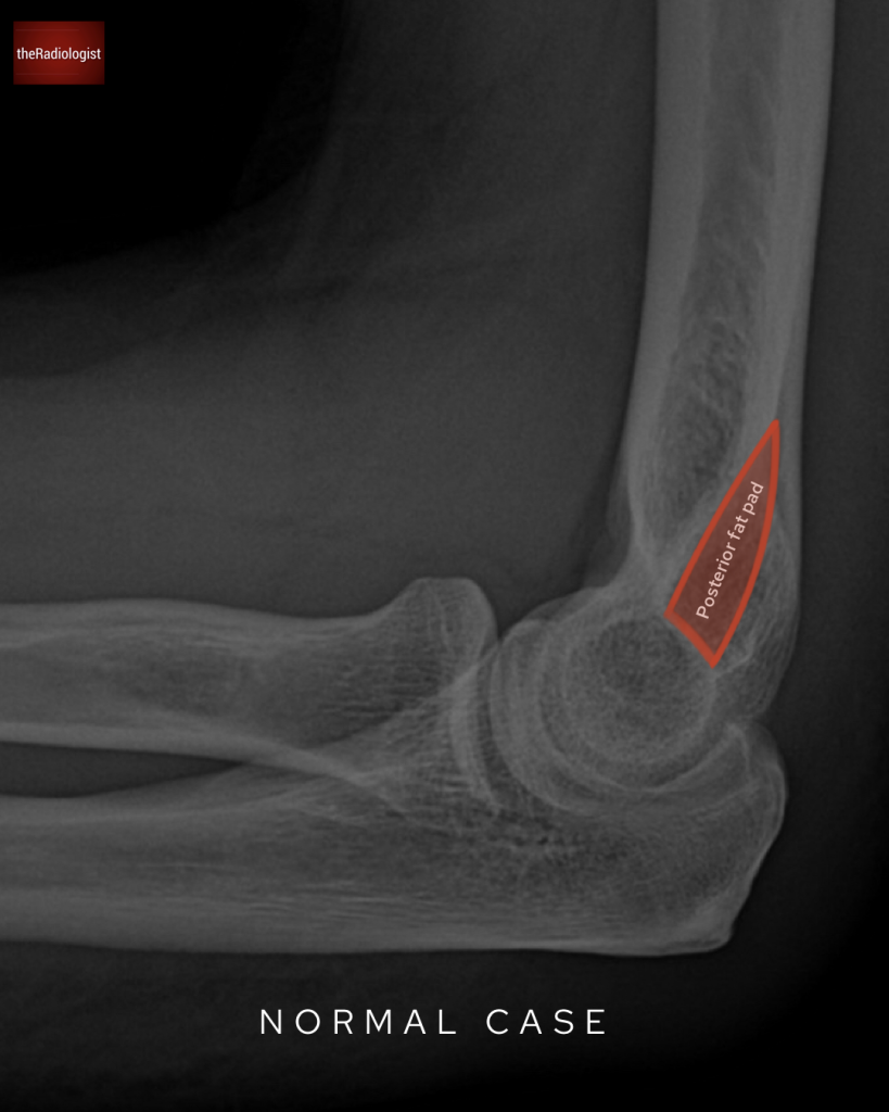 Elbow fat pads – the Radiologist