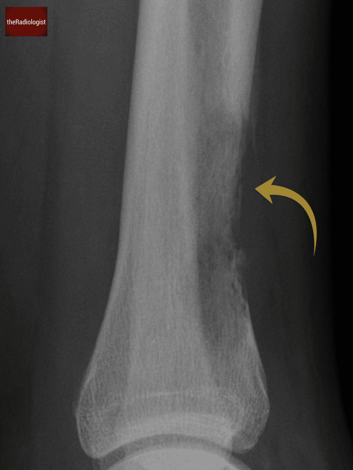 Lytic Bone Metastases | Imaging Features and Causes