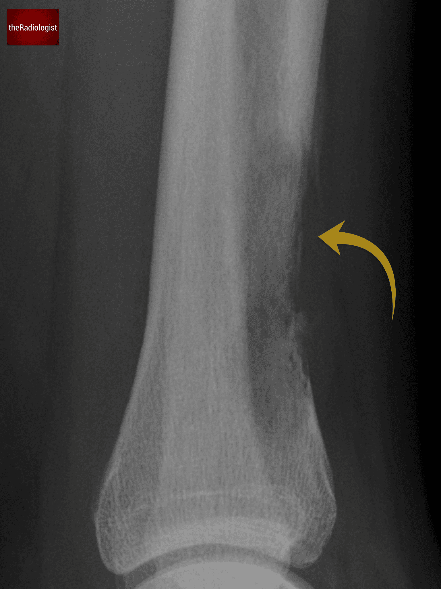 Lytic Bone Metastases | Imaging Features and Causes