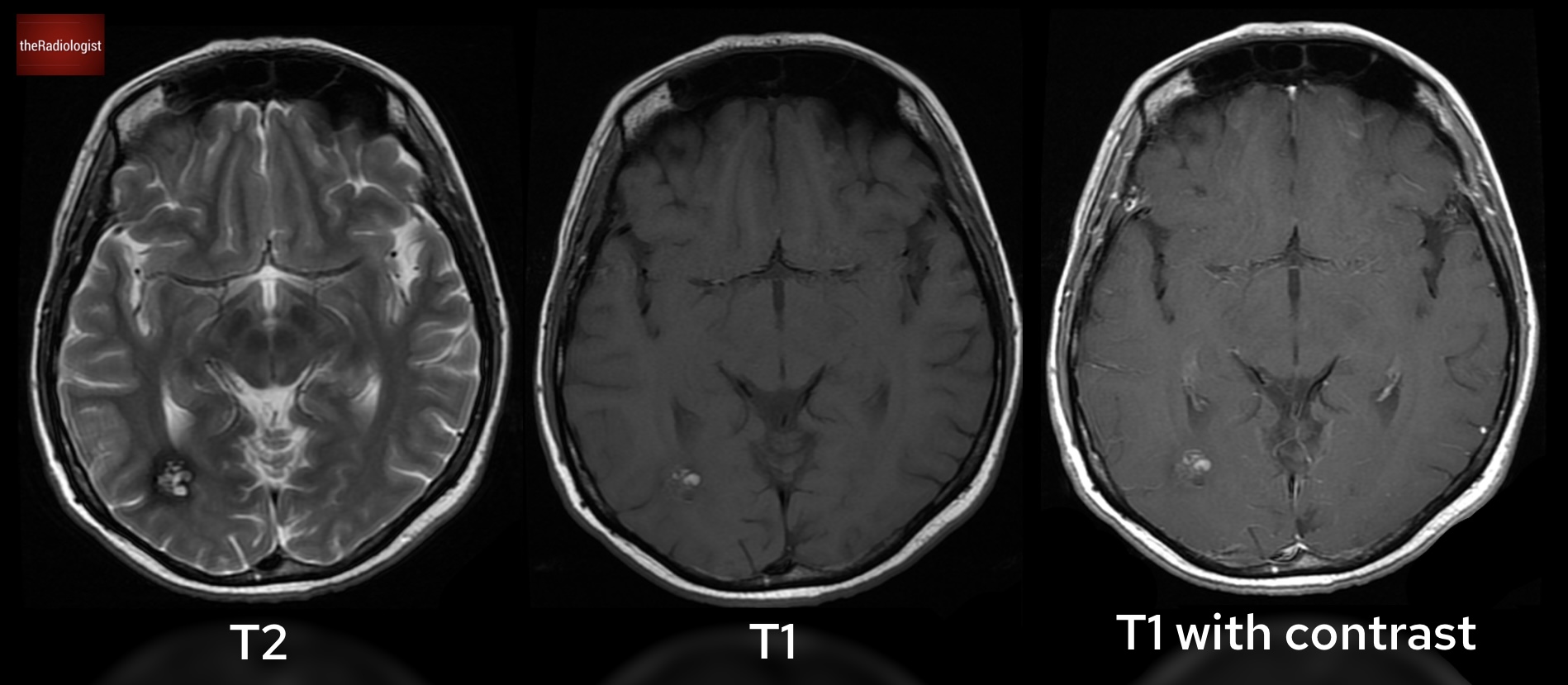Cavernoma CT Head Case | Brain Cavernous Malformation
