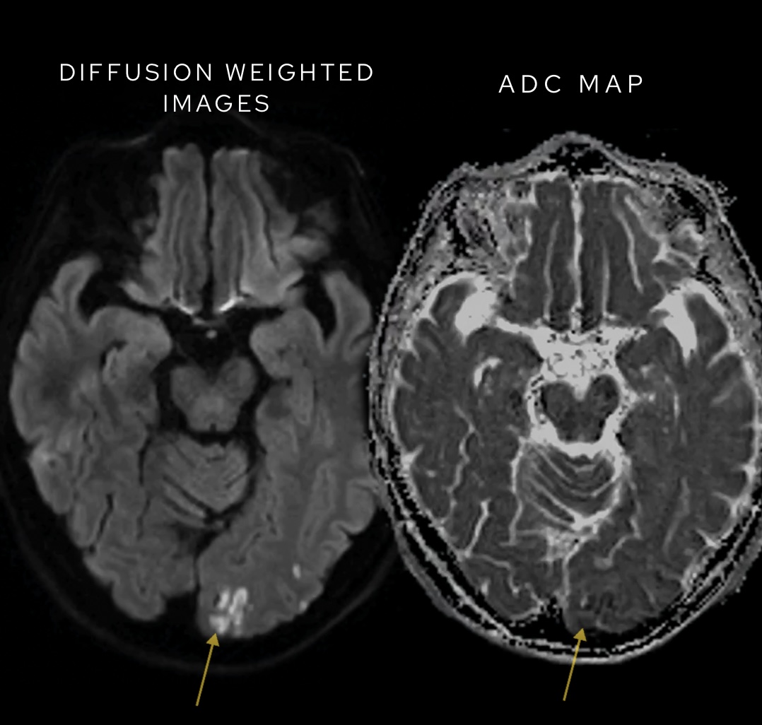 Multiple space occupying lesions – the Radiologist