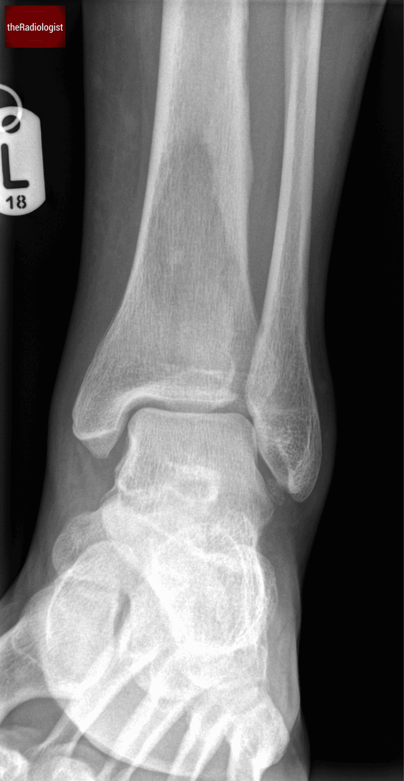 Lytic Bone Metastases | Imaging Features and Causes
