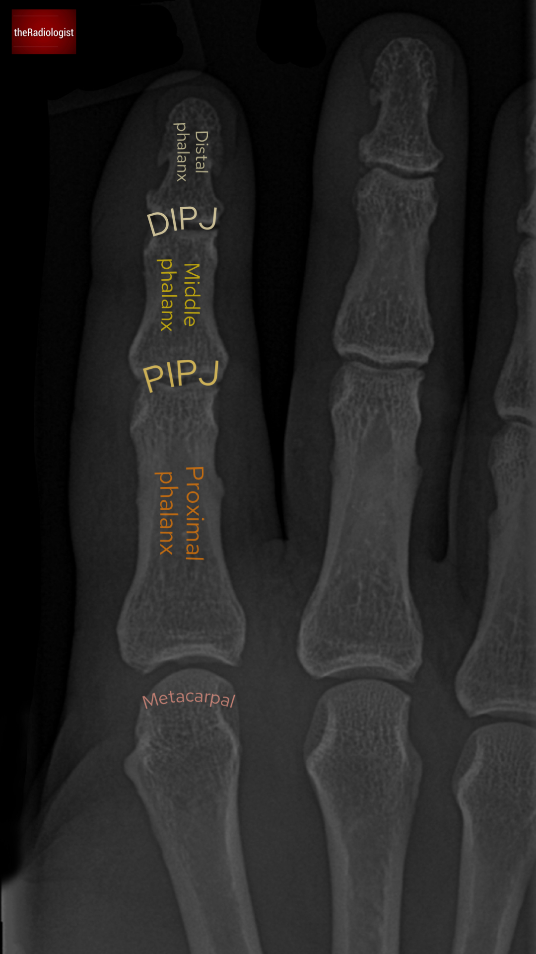 Volar plate injuries – the Radiologist