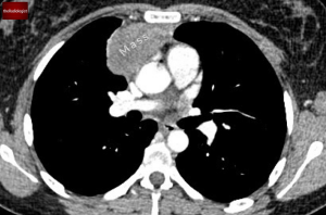Anterior mediastinal mass lesions - the Radiologist