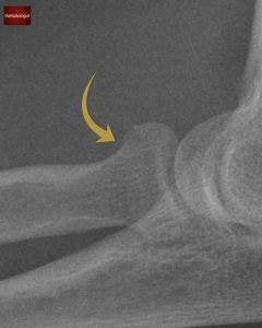 Elbow X-Ray Essentials – the Radiologist