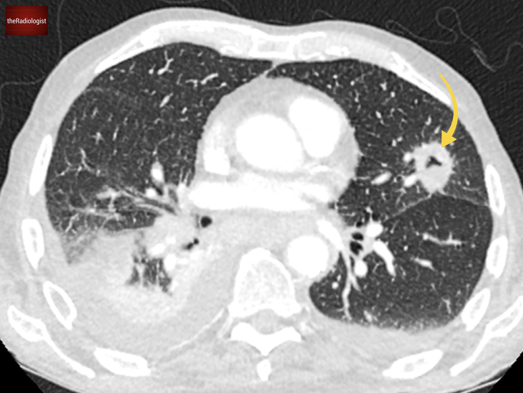 Multiple cavitating lesions – the Radiologist