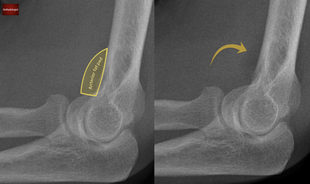 Elbow fat pads – the Radiologist