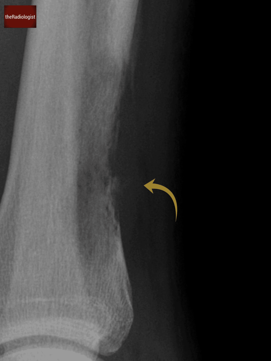Lytic bone metastases – the Radiologist