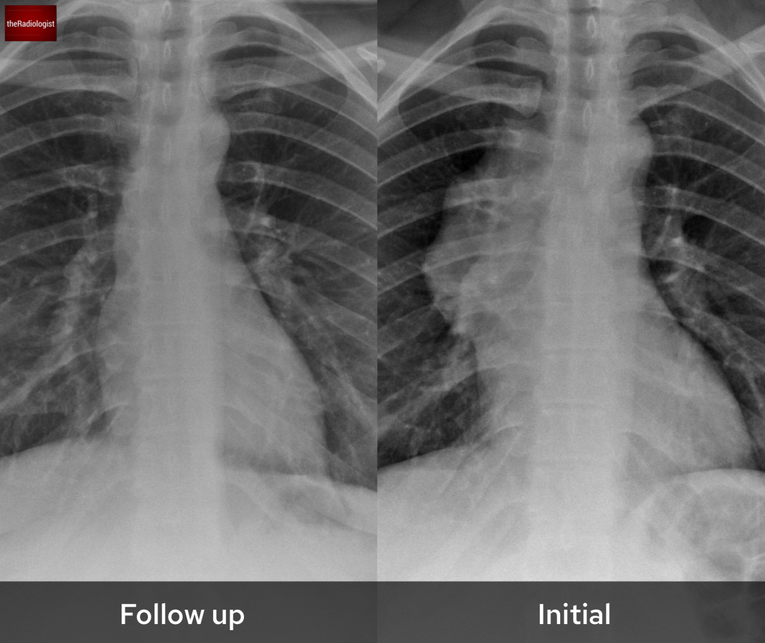 Anterior mediastinal mass lesions – the Radiologist